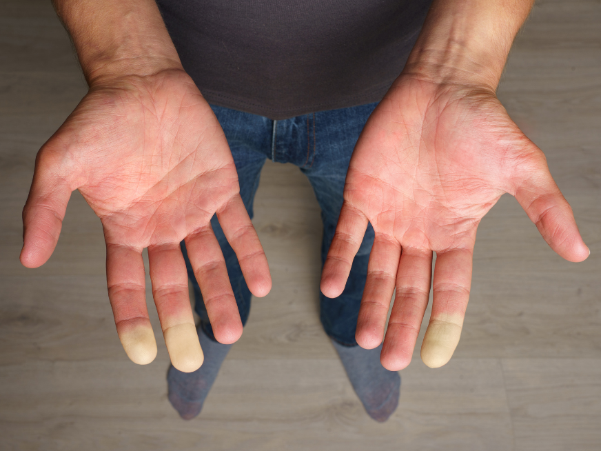 S ndrome De Raynaud Claves Sobre La Enfermedad Grupo Gamma